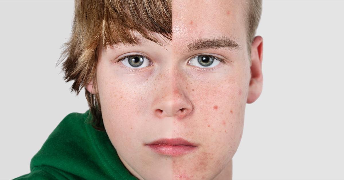 O que é puberdade precoce e quando é necessário bloquear os hormônios ...